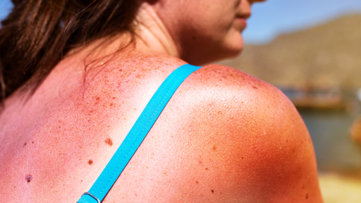 NIH study reveals how melanoma spreads